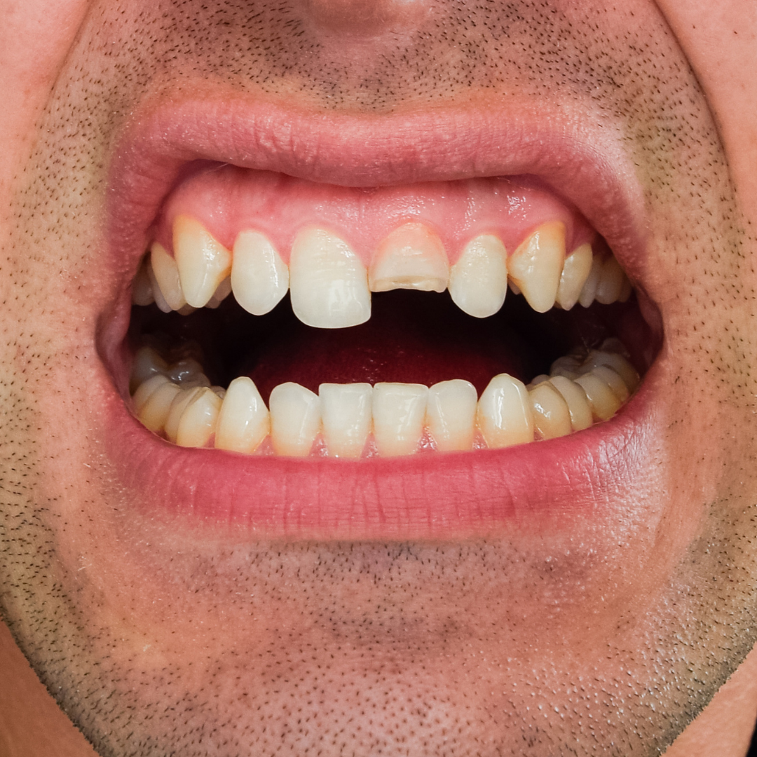 I’ve had an accident and broken a tooth/lost a tooth what should I do ...