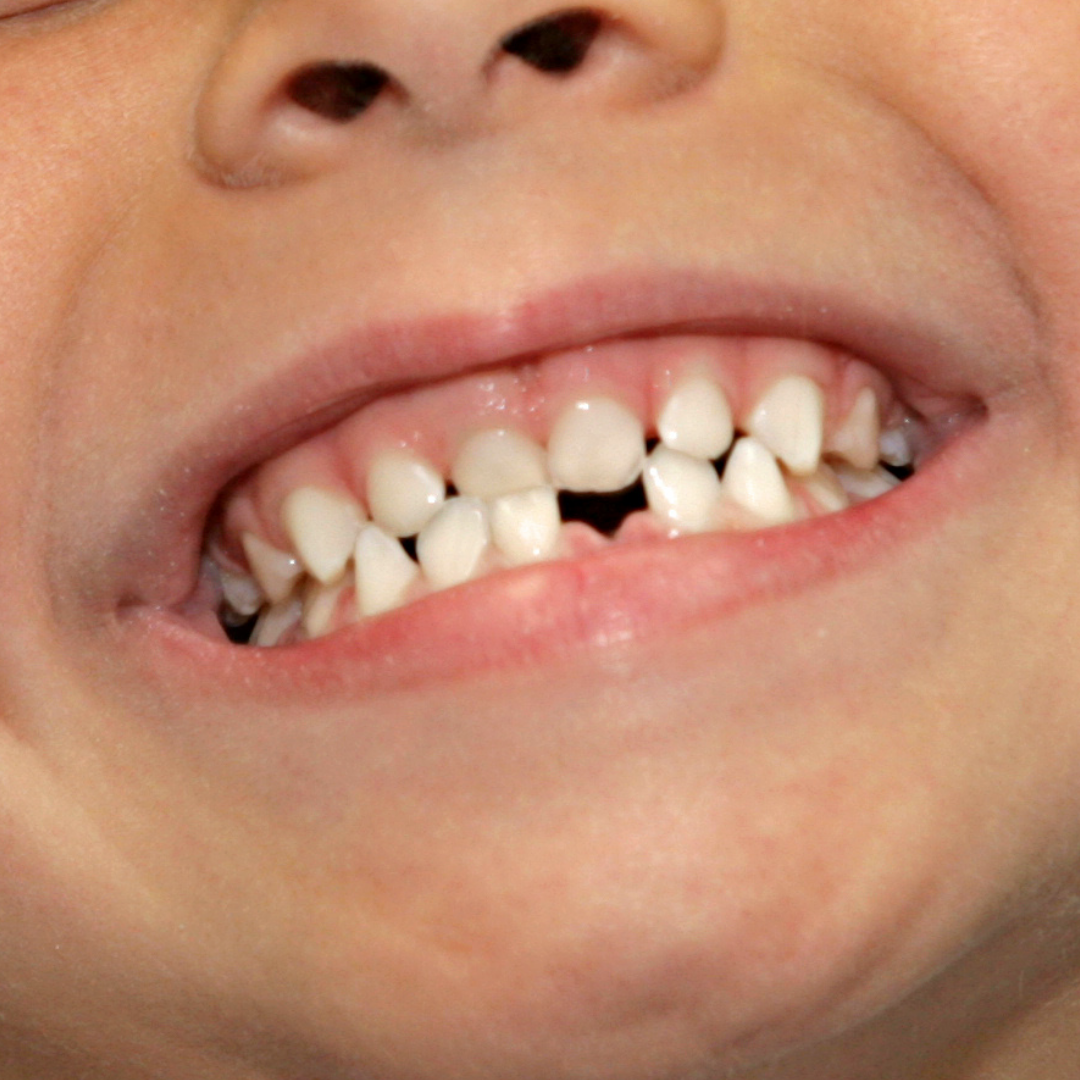 I’ve had an accident and broken a tooth/lost a tooth what should I do ...